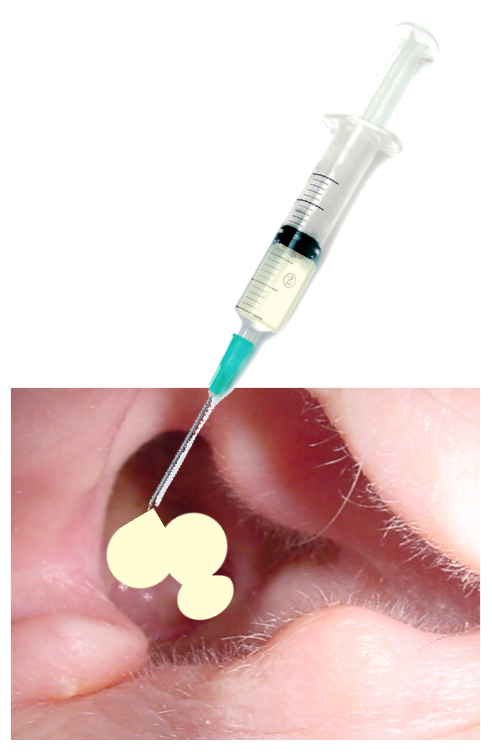 Injection d’antibiotique ou d’antimycotique dans la cavité de mastoïde ...